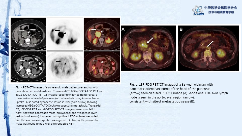 中华医学会核医学分会 病例报告 病例77：胰腺神经内分泌肿瘤PET-CT显像一例-【CSNM继教学组】缪蔚冰 福建医科大学附属第一医院