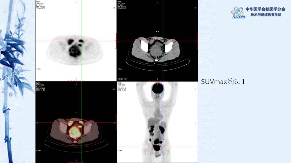 中华医学会核医学分会 病例报告 病例56：颅内生殖细胞瘤术后腹腔转移PET-CT显像一例-【CSNM继教学组】黄占文 西南医科大学附属医院核医学科