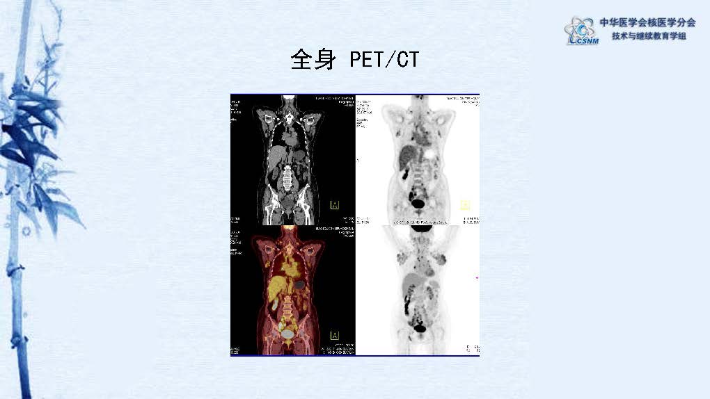 中华医学会核医学分会 病例报告 病例19： PET-CT诊断淋巴瘤一例-【CSNM继教学组】包建英