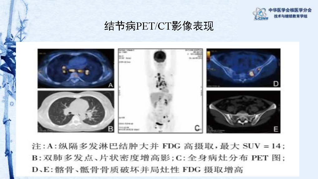 中华医学会核医学分会 病例报告 病例19： PET-CT诊断淋巴瘤一例-【CSNM继教学组】包建英