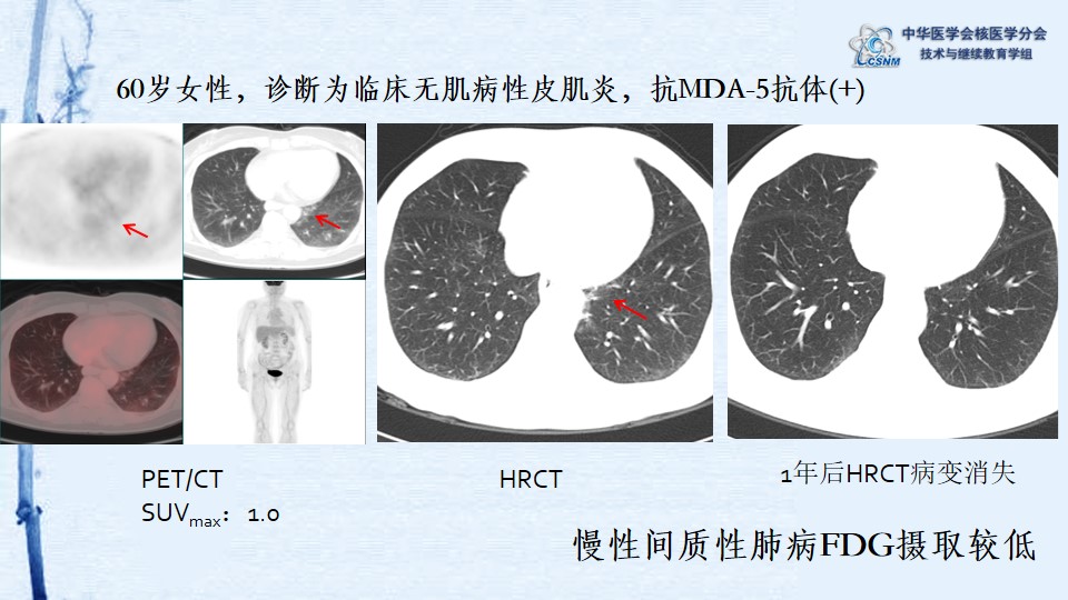 中华医学会核医学分会 讲座 【CSNM继教学组】讲座E12 李原 PET/CT在间质性肺病诊治中应用