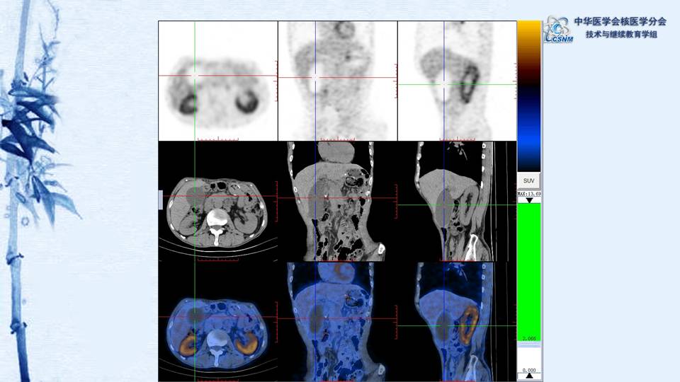 中华医学会核医学分会 病例报告 病例67：PET/CT显像一例-【CSNM继教学组】佟正灏 北京大学第一医院