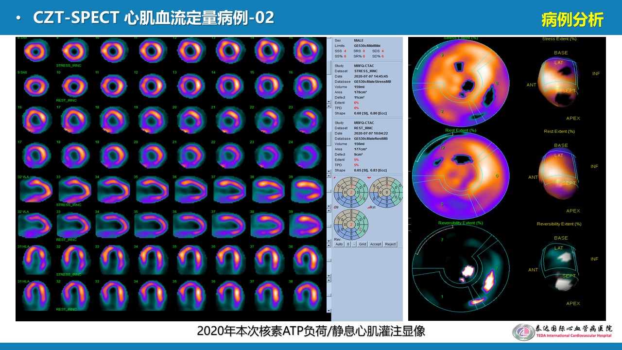 中华医学会核医学分会 核汇园 【核汇园】之（85）- 李剑明教授讲授《CZT心脏SPECT临床研究及进展》