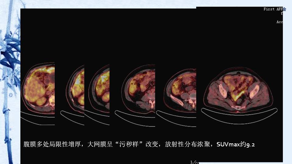 中华医学会核医学分会 病例报告 病例7-恶性弥漫型腹膜间皮瘤PET/CT显像一例-【CSNM继教学组】程兵