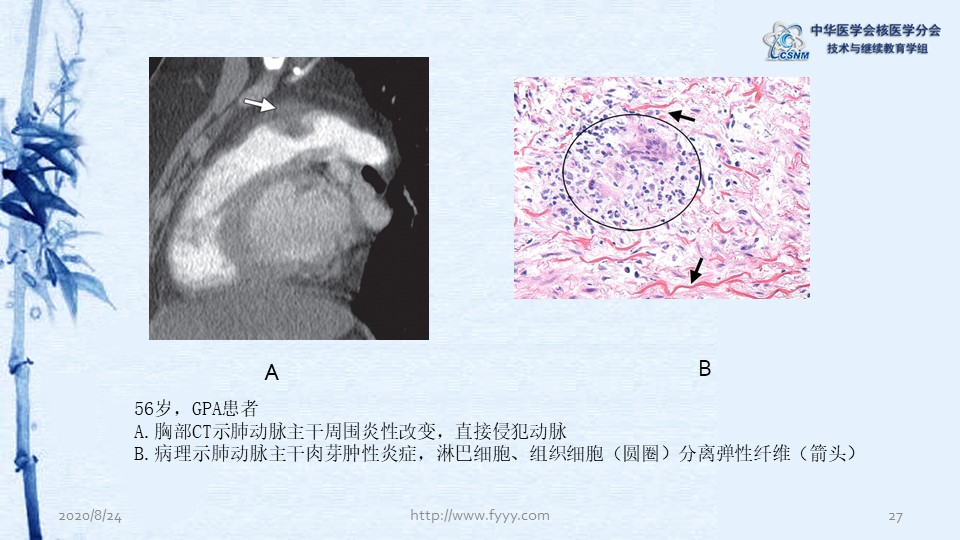 中华医学会核医学分会 病例报告 病例82：肉芽肿性血管炎PET-CT显像一例-【CSNM继教学组】郑山 福建医科大学附属第一医院