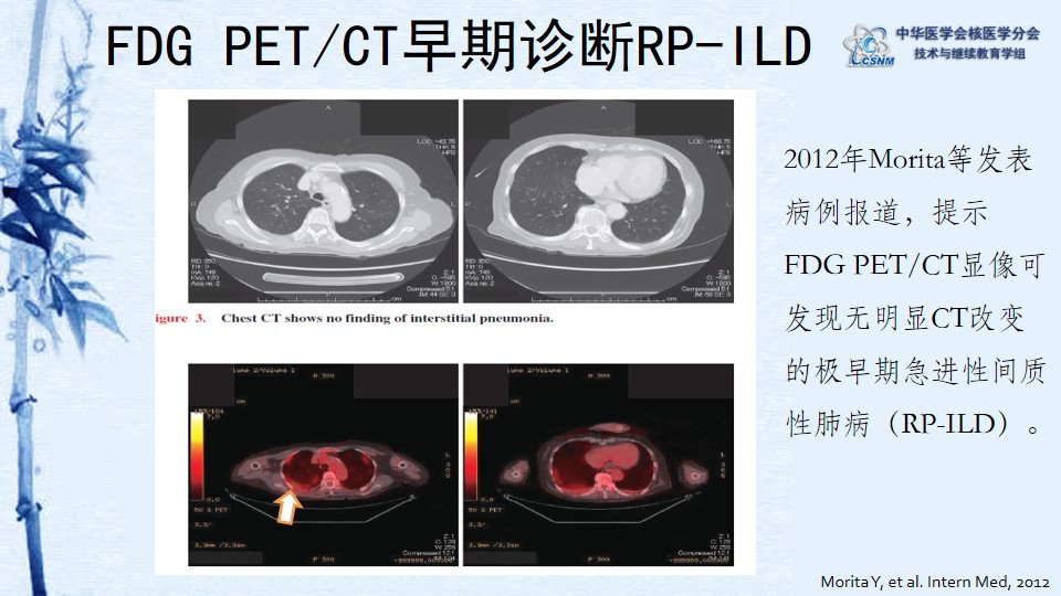 中华医学会核医学分会 讲座 【CSNM继教学组】讲座E12 李原 PET/CT在间质性肺病诊治中应用