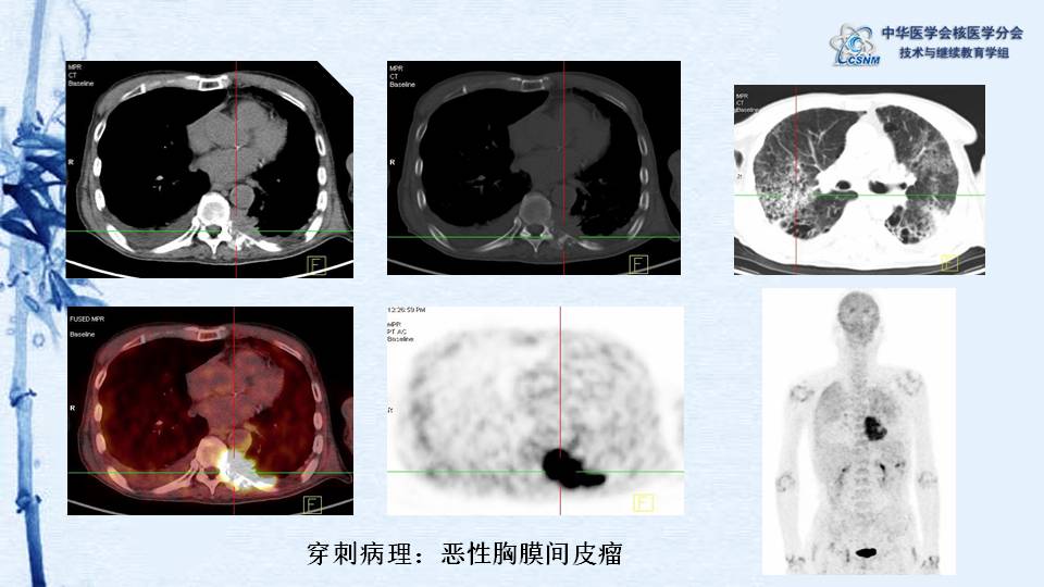 中华医学会核医学分会 病例报告 病例18：胸腺瘤PET-CT显像一例-【CSNM继教学组】李凤岐