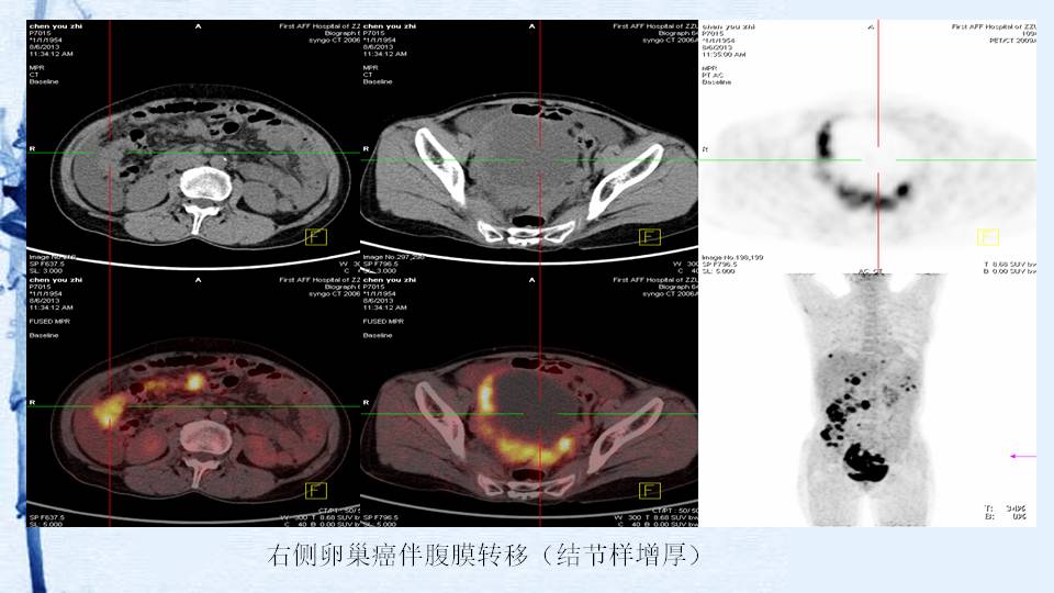 中华医学会核医学分会 病例报告 病例7-恶性弥漫型腹膜间皮瘤PET/CT显像一例-【CSNM继教学组】程兵