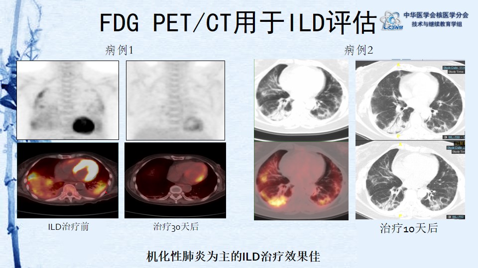 中华医学会核医学分会 讲座 【CSNM继教学组】讲座E12 李原 PET/CT在间质性肺病诊治中应用