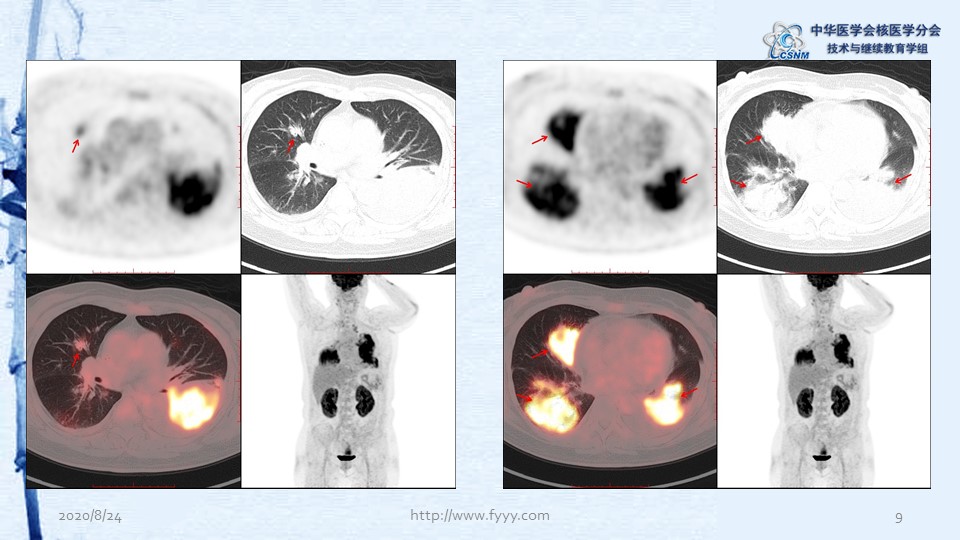 中华医学会核医学分会 病例报告 病例82：肉芽肿性血管炎PET-CT显像一例-【CSNM继教学组】郑山 福建医科大学附属第一医院