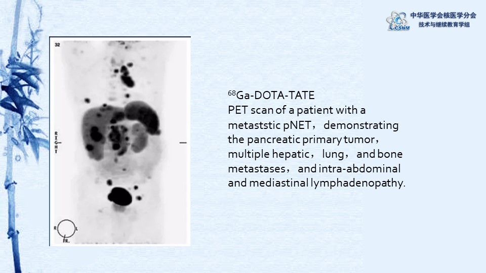 中华医学会核医学分会 病例报告 病例77：胰腺神经内分泌肿瘤PET-CT显像一例-【CSNM继教学组】缪蔚冰 福建医科大学附属第一医院