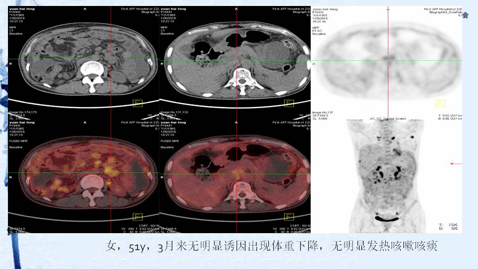 中华医学会核医学分会 病例报告 病例7-恶性弥漫型腹膜间皮瘤PET/CT显像一例-【CSNM继教学组】程兵
