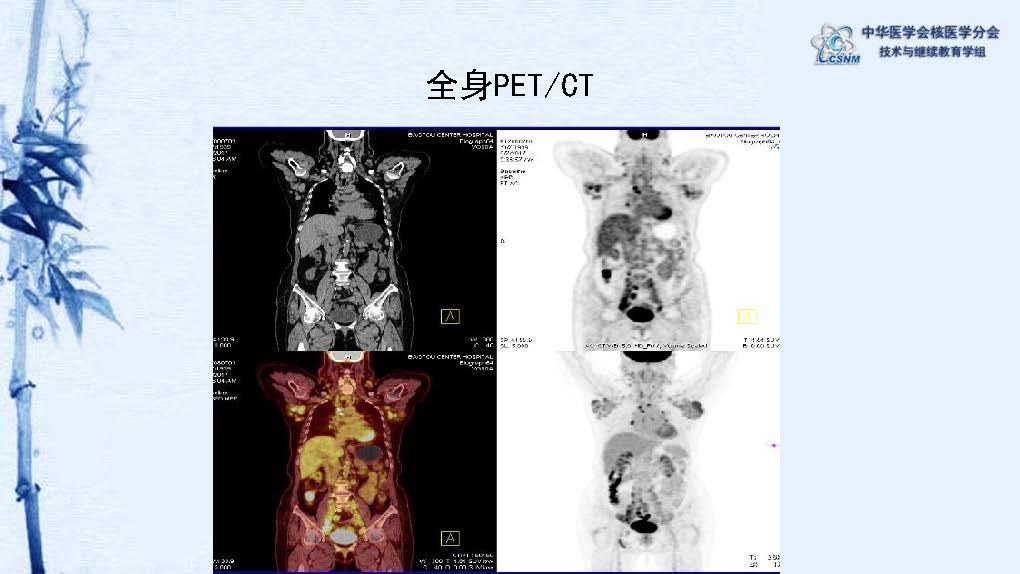 中华医学会核医学分会 病例报告 病例19： PET-CT诊断淋巴瘤一例-【CSNM继教学组】包建英