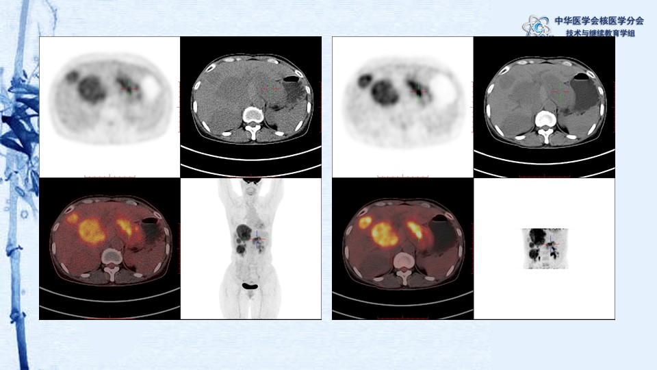 中华医学会核医学分会 病例报告 病例77：胰腺神经内分泌肿瘤PET-CT显像一例-【CSNM继教学组】缪蔚冰 福建医科大学附属第一医院