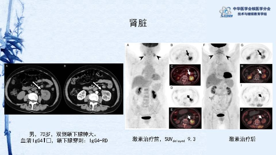 中华医学会核医学分会 病例报告 病例67：PET/CT显像一例-【CSNM继教学组】佟正灏 北京大学第一医院