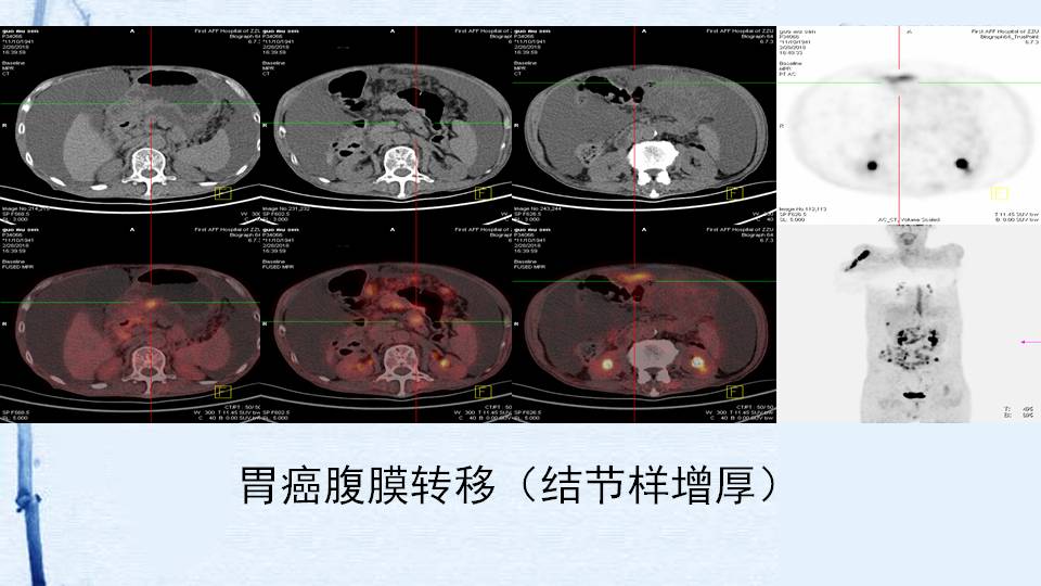 中华医学会核医学分会 病例报告 病例7-恶性弥漫型腹膜间皮瘤PET/CT显像一例-【CSNM继教学组】程兵