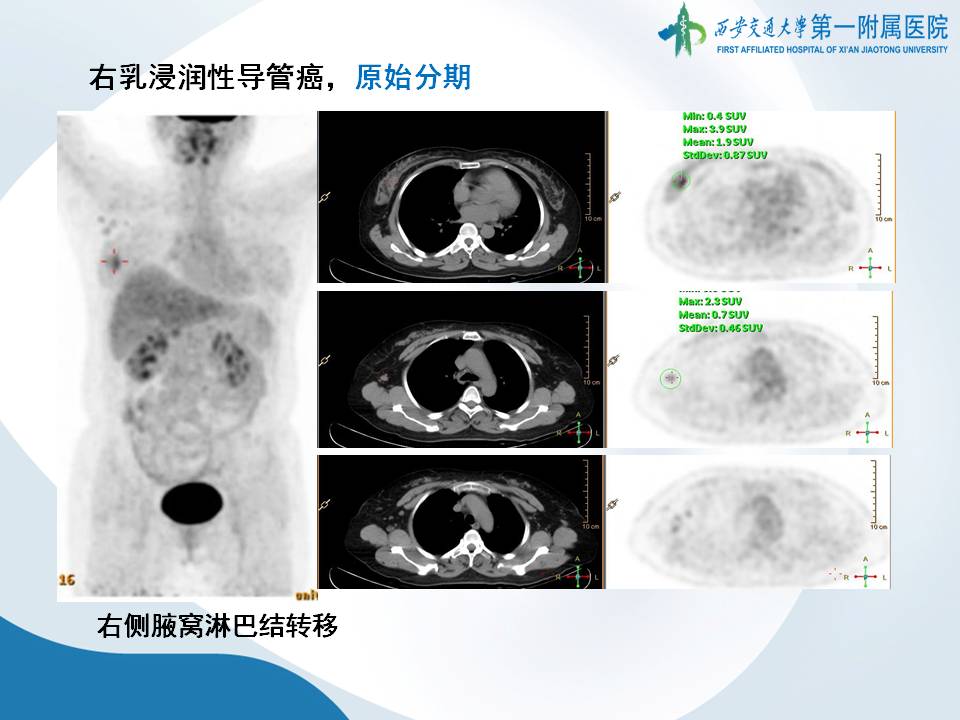 中华医学会核医学分会 核汇园 【核汇园】017 段小艺教授讲授乳腺癌多模态成像及策略