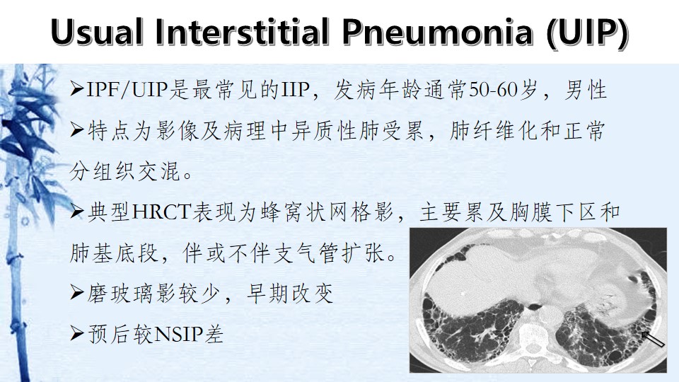 中华医学会核医学分会 讲座 【CSNM继教学组】讲座E12 李原 PET/CT在间质性肺病诊治中应用